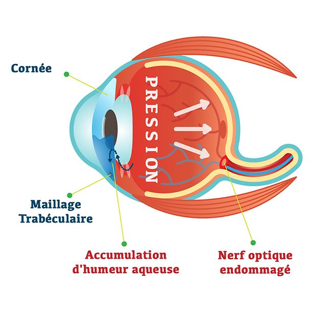 Glaucome - Symptômes, Conséquences, Traitements | Vision Direct